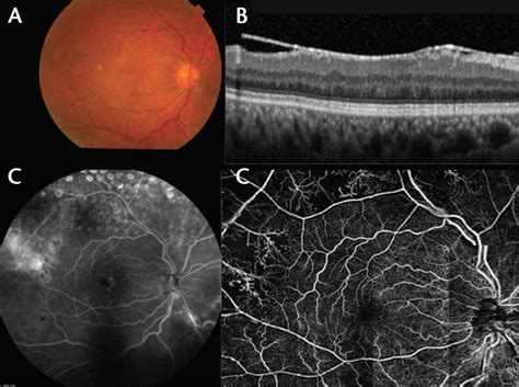 Retina Today Panoramic Imaging With OCTA April
