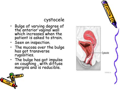 Genital Prolapse Ppt Download