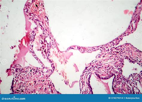 Lobar Pneumonia During The Hemorrhagic Edema Period Light Micrograph