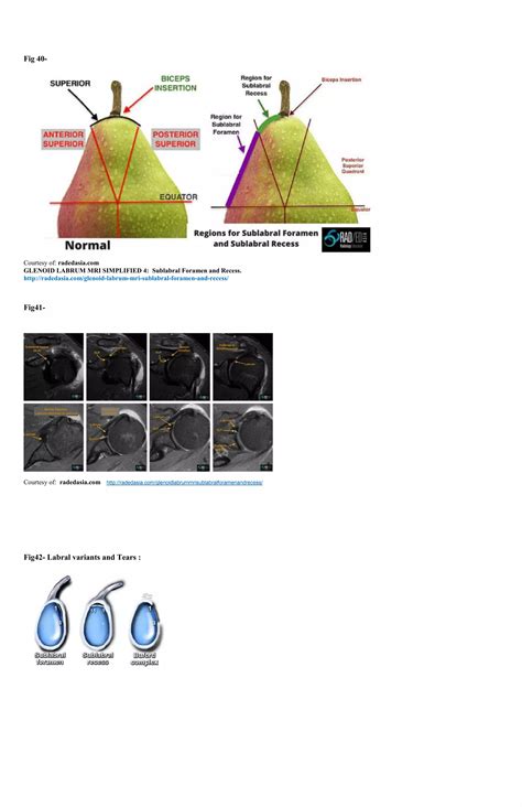 Normal Labral Variant Figures Ii Walif Chbeir Pdf
