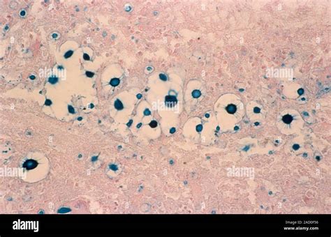 Brain In Cryptococcosis Light Micrograph Of A Section Through A Brain