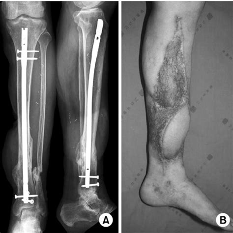 The Type Iiib Open Fracture Of Tibia Was Healed Without Infection And Download Scientific