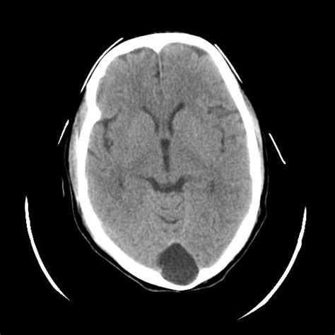 Brainpathology1 Object Detection Dataset By Ai