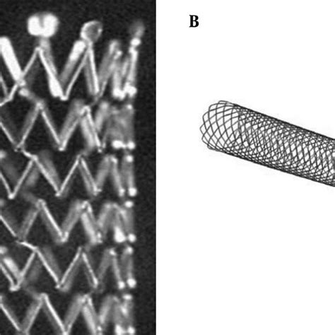 Pdf Comparison Of Open Cell Stent And Closed Cell Stent For Treatment