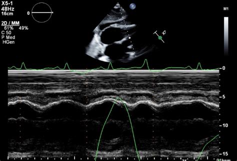 Rv Diastolic Collapse Tamponade Toolbox