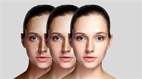 Skin Pigmentation Disorder Guide Revitalize With Expert Insights