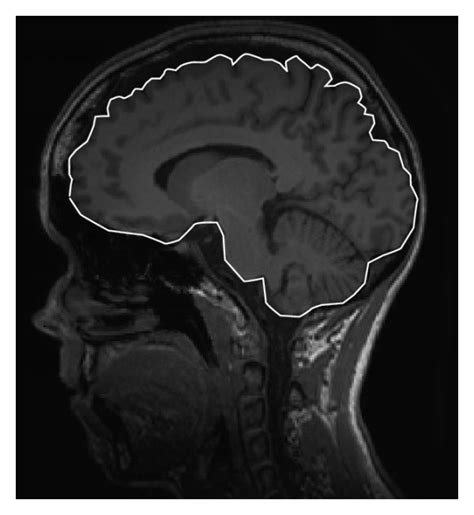 segmentation of the brain surface using deformable models a a closed