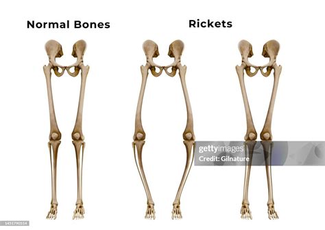 Rickets Is A Metabolic Disease Characterized By Deformities Of The