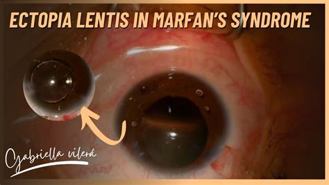 Ectopia Lentis In Marfans Syndrome Youtube