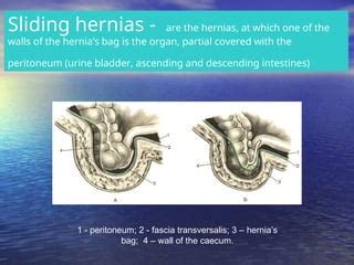A Hernia Is The Abnormal Protrusion Of An Organ Or Tissue Through A