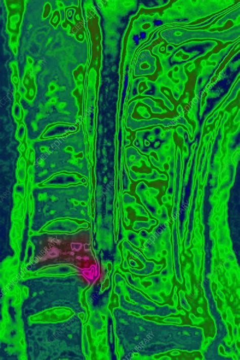 Herniated Disk Mri Stock Image C029 7722 Science Photo Library