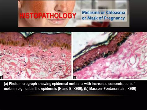 Disorders Of Hyperpigmentation Pptx