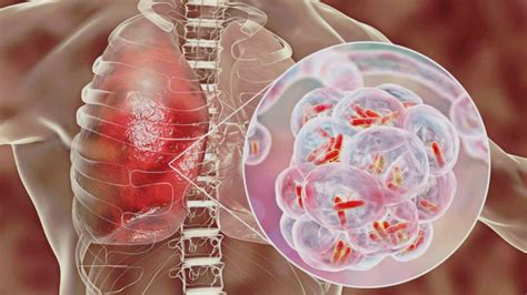 Latent TB Vs Active TB Whats The Difference