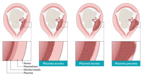 Postpartum Hemorrhage Exams Naxlex Nursing