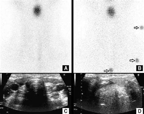 Thyroid Scintigraphy A B And Us C D Of A 13 Year Old Boy With