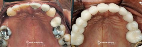 Bicuspid Teeth Extraction Reversal