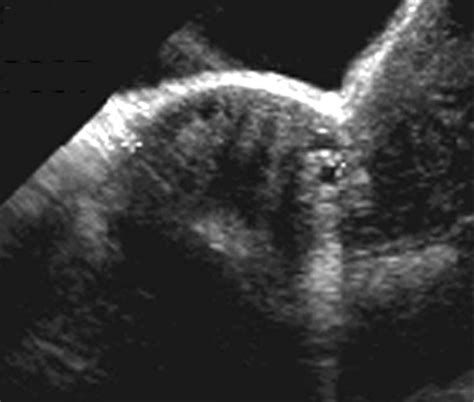 Quiz 3 Sex Cord Stromal Tumors Flashcards Quizlet