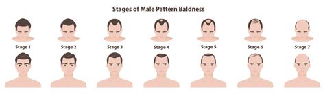 Hair Loss Stages Vector Art Icons And Graphics For Free Download