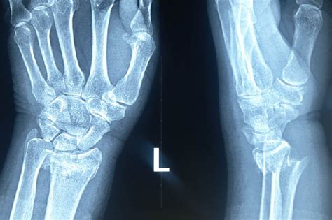 Colles骨折影像图 百度健康·医学科普