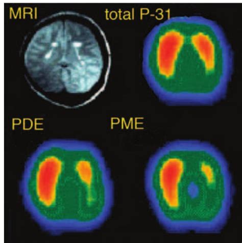Phosphorus 31 Magnetic Resonance Spectroscopic Images Mrsi