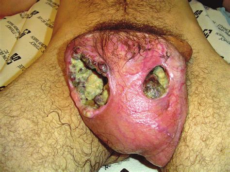 Extensive Necrosis On The Right Hemiscrotum Download Scientific Diagram