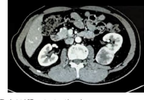 Figure 1 From Laparoscopic Single Port Radical Nephrectomy Challenges A Case Presentation