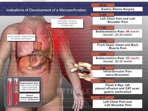 Indications Of Development Of A Microperforation Trial Exhibits