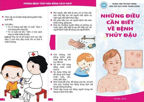 Những điều cần biết về bệnh thủy đậu CDC Hà Nam