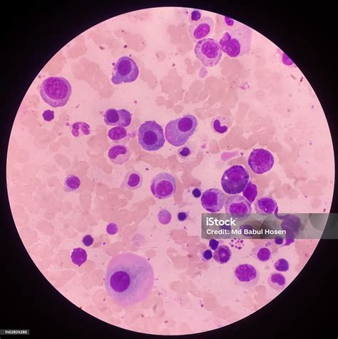 Bone Marrow Study Plasma Cell Dyscrasia Or Multiple Myeloma Present