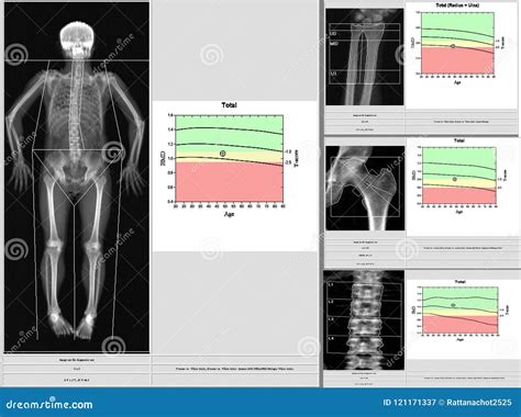 Bone Density DEXA Scan Osteoporosis Diagnosis Stock Photography CartoonDealer Com 112414100