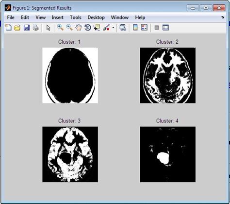 Brain Tumor Segmentation Using Back Propagation Neural Network