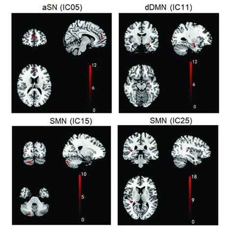 Brain Regions With Significant Differences In Intra Network