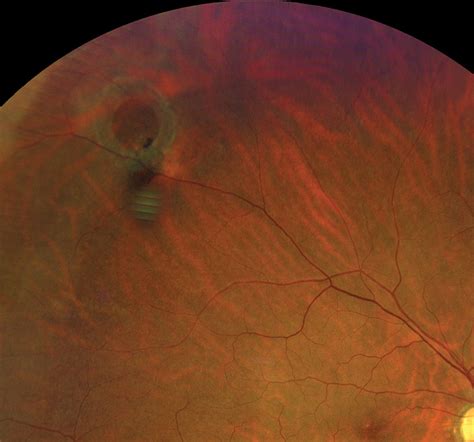 Operculated Tear