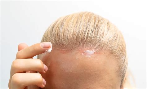 The Ultimate Guide To Dht Blockers For Women