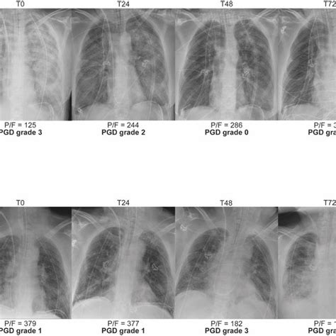 Grading Of Primary Graft Dysfunction Pgd After Lung Transplantation Download Scientific