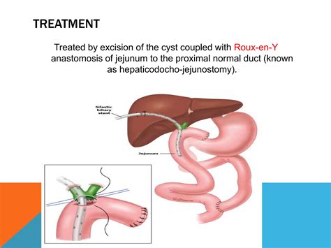 Choledochal Cyst Pptx