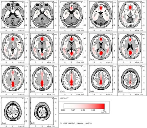 Figure 1 From Theta Eeg Source Localization Using Loreta In Partial