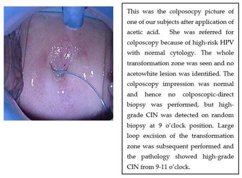 The Value Of Four Quadrant Cervical Biopsy In Women With Different Colposcopic Impressions