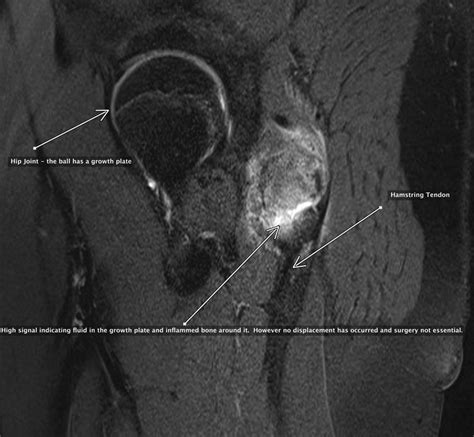 Traction Apophysitis Of Ischium Ballaratosm Ballarat Orthopaedics And Sports Medicine