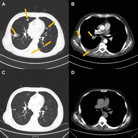 The Lung And Pleural Metastasis Were Reduced After Everolimus