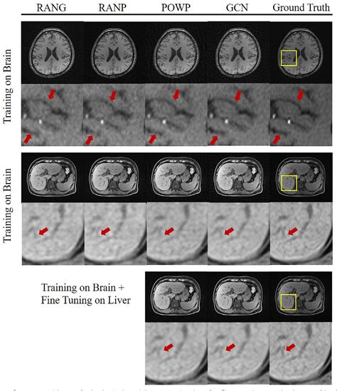 Figure 4 From A Self Supervised Learning Framework For Under Sampling Pattern Design Using Graph