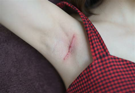 Ingrown Hair Prevation Of Ingrown Or Encapsulated Hair
