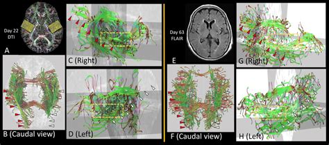 Diffusion Tensor Tractography Was Performed On Day 22 The Regions Of Download Scientific