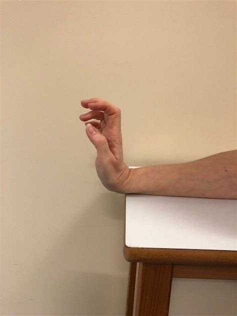 Hand Therapy Exercises Following Metacarpal Phalangeal Joint Mcpj