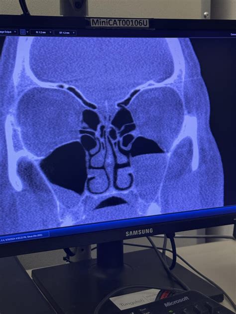 Chronic Post Nasal Drip Rsinusitis