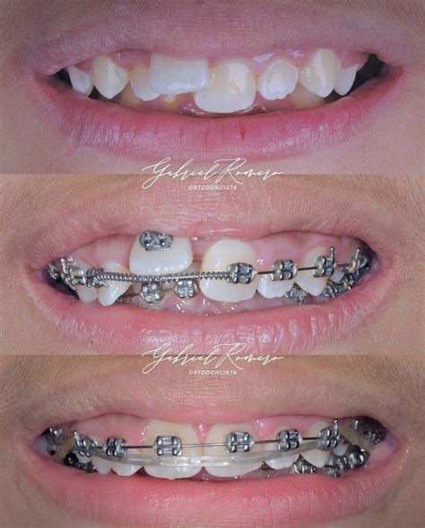 Finishing Procedures In Orthodontics Dental Dimensions And Proportions Microesthetics Artofit