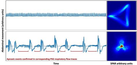 P102 Symmetric Projection Attractor Reconstruction Spar Whole Waveform Analysis Of Abdominal