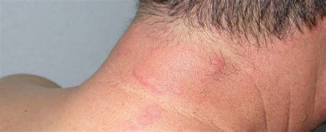 Causes Symptoms Of Urticaria E International Health