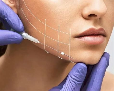 Pdo Threads The District Injector Med Spa Washington Dc