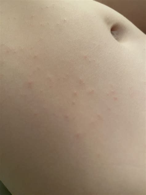 Сыпь у ребенка на теле 3 года 3 дня назад все тело покрылось мелкой сыпью Medaboutme